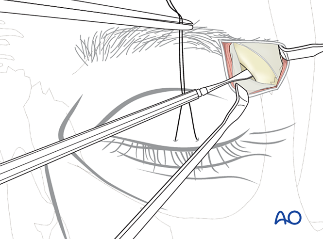 Lateral eyebrow approach
