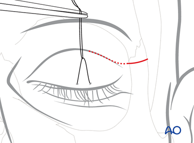 Upper eyelid approach