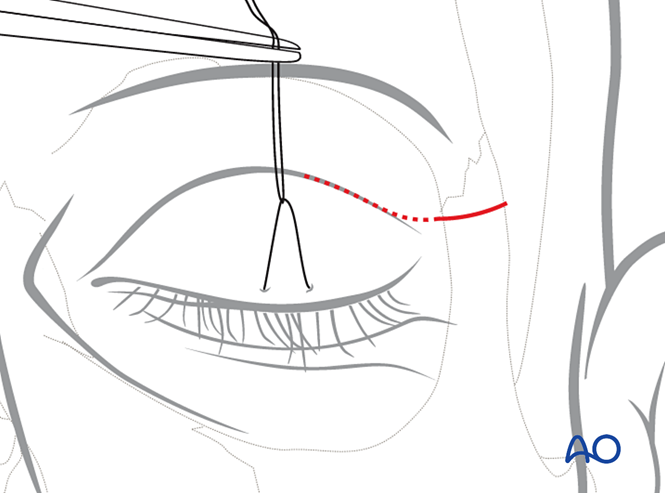 Upper eyelid approach