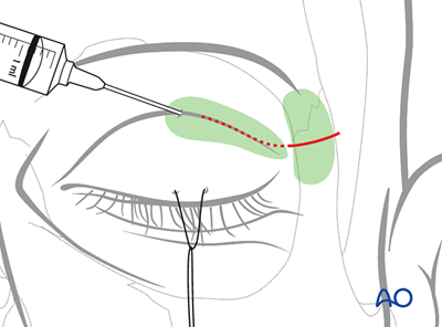 Upper eyelid approach