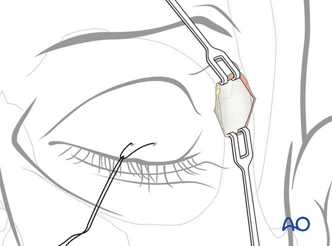 Upper eyelid approach
