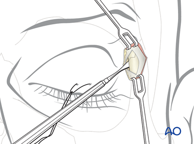 Upper eyelid approach
