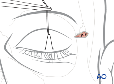 Upper eyelid approach