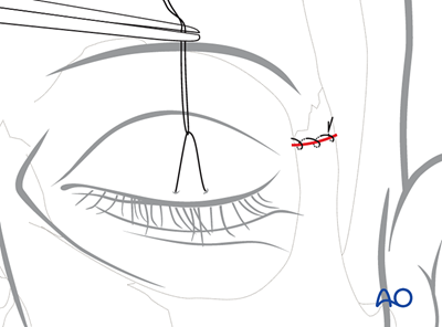 Upper eyelid approach