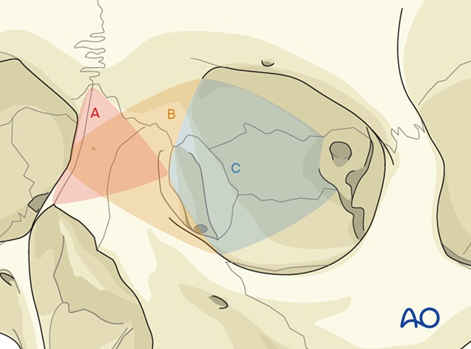 Extended glabellar approach (horizontal Y approach)