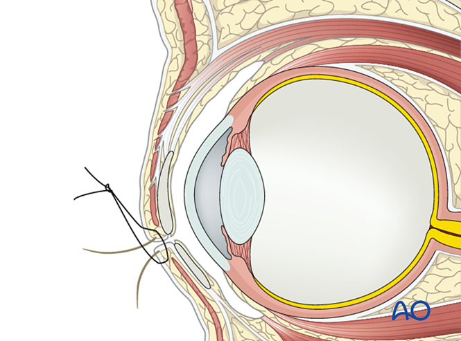 Extended glabellar approach (horizontal Y approach)