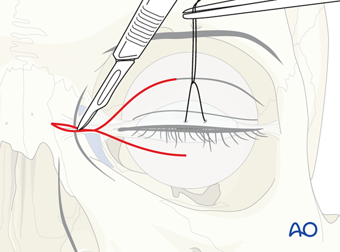 Extended glabellar approach (horizontal Y approach)