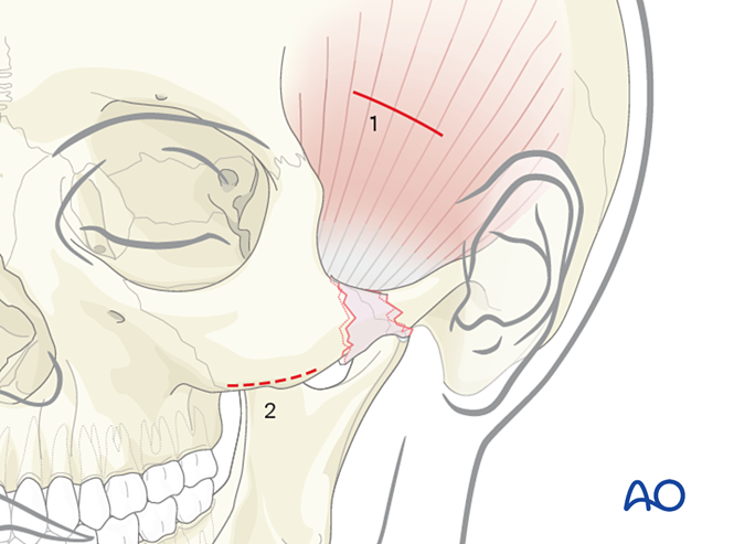 Indirect approaches to the zygomatic arch (temporal and transoral ...