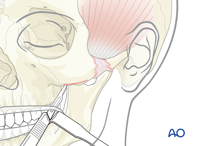 Indirect approaches to the zygomatic arch (temporal and transoral ...