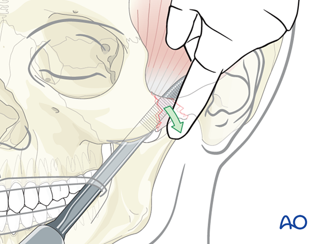 Indirect approaches to the zygomatic arch (temporal and transoral ...