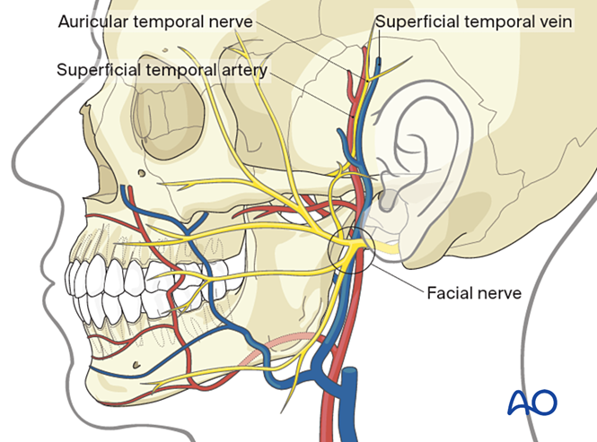 Preauricular approach