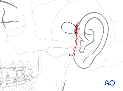 Preauricular approach