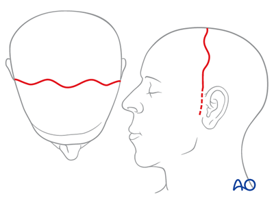 Coronal approach