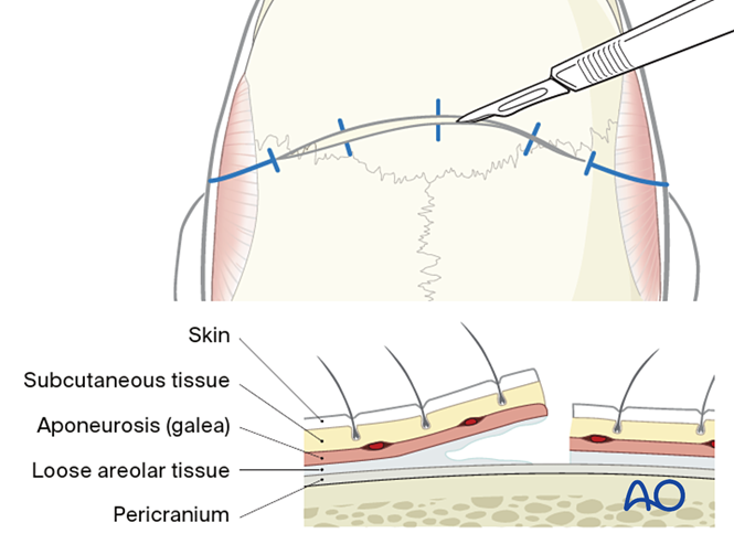 Coronal approach
