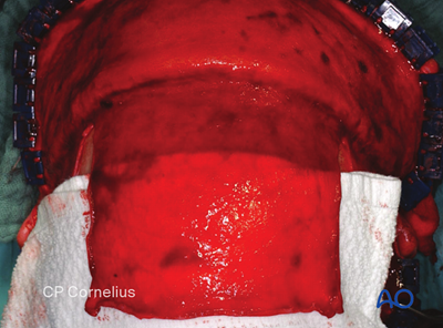 Coronal approach