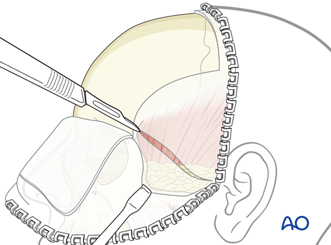 Coronal approach