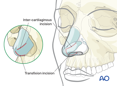 Endonasal approaches (transfixion incision and intercartilaginous ...