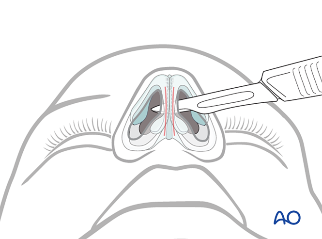 Endonasal approaches (transfixion incision and intercartilaginous ...