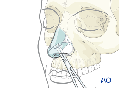 Endonasal approaches (transfixion incision and intercartilaginous ...