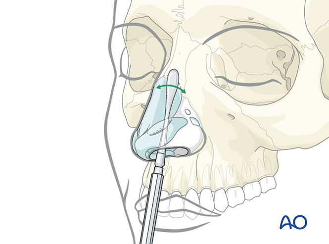 Endonasal approaches (transfixion incision and intercartilaginous ...