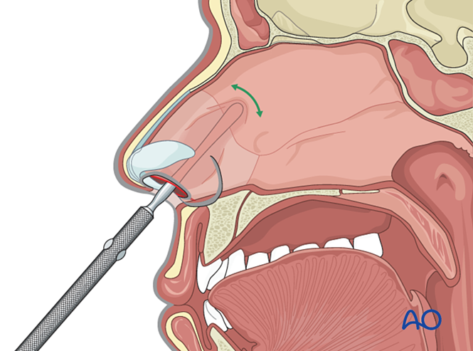 Endonasal approaches (transfixion incision and intercartilaginous ...