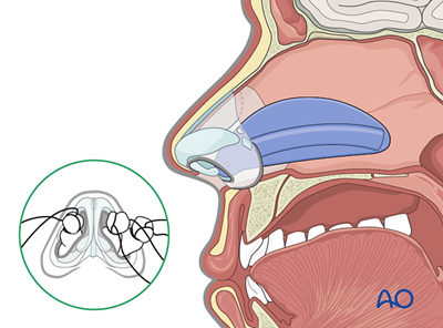 Endonasal approaches (transfixion incision and intercartilaginous ...
