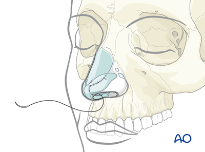 Endonasal approaches (transfixion incision and intercartilaginous ...