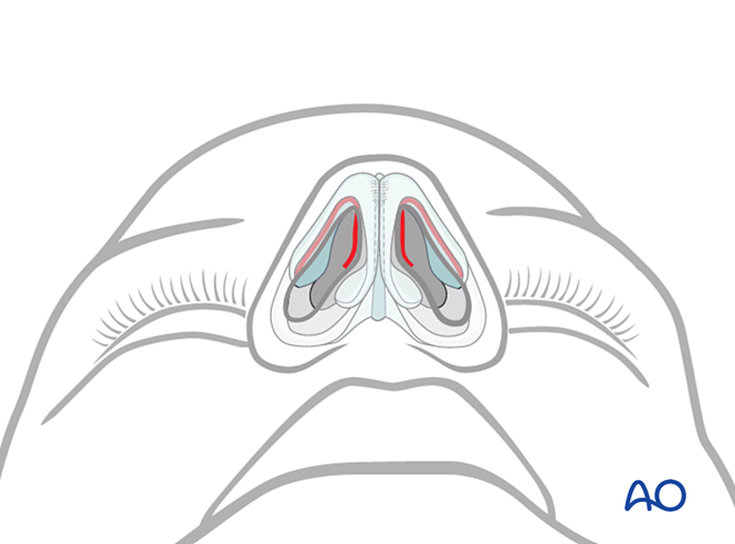 External rhinoplasty approach (open)