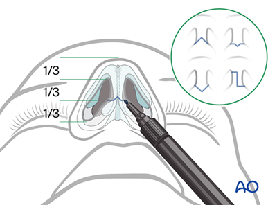 External rhinoplasty approach (open)