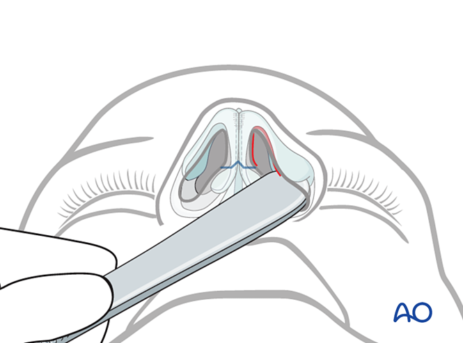 External rhinoplasty approach (open)