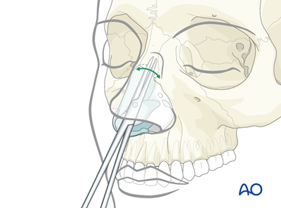 External rhinoplasty approach (open)