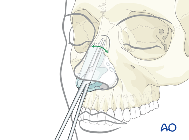 All approaches for the management of midface injuries