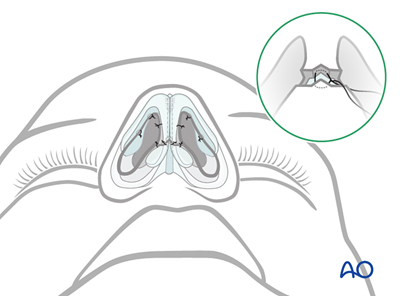External rhinoplasty approach (open)