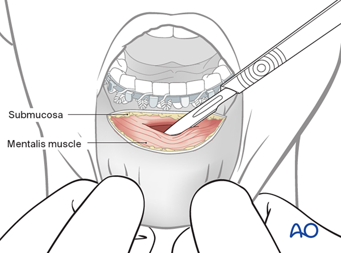 Transoral approach to the symphysis and body