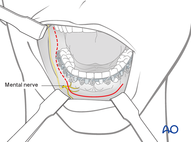Transoral approach to the symphysis and body
