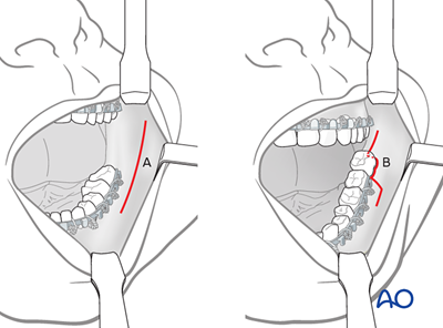 Transoral approach to the angle