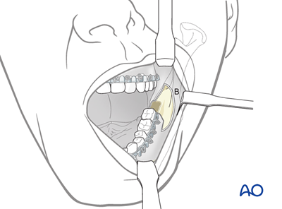 Transoral approach to the angle