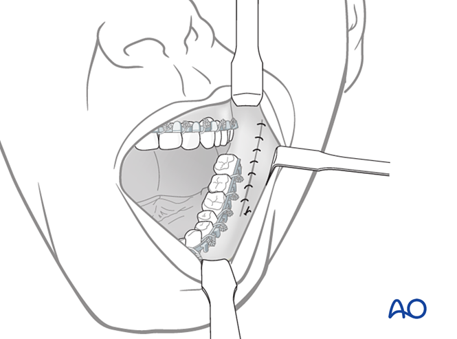 Transoral approach to the condylar process and ramus