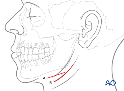 Submandibular approach