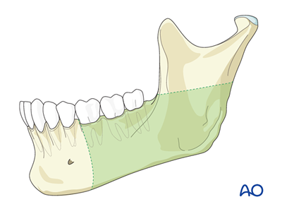 Submandibular approach