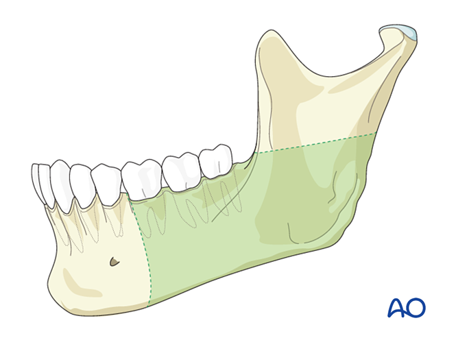Submandibular approach