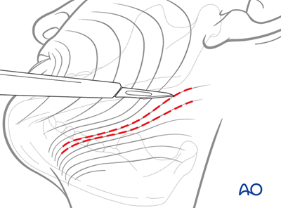 Submandibular approach