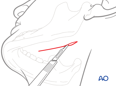 Submandibular approach