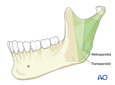 Retromandibular approaches