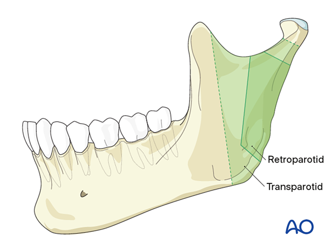 Retromandibular approaches