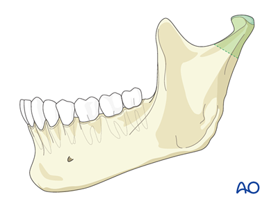 Preauricular approach
