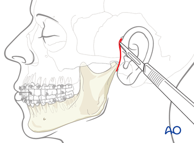 Preauricular approach