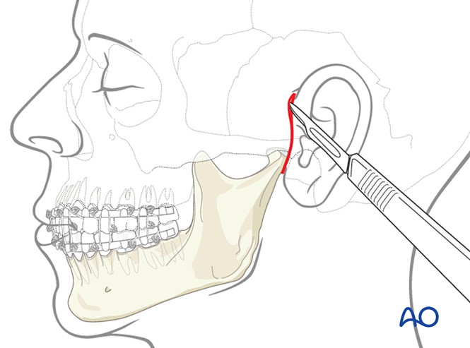 Preauricular approach