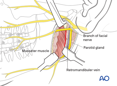 Retromandibular approaches