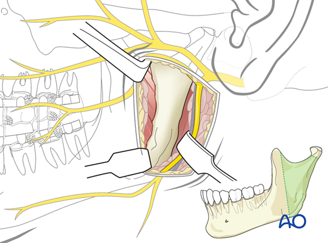 Retromandibular approaches
